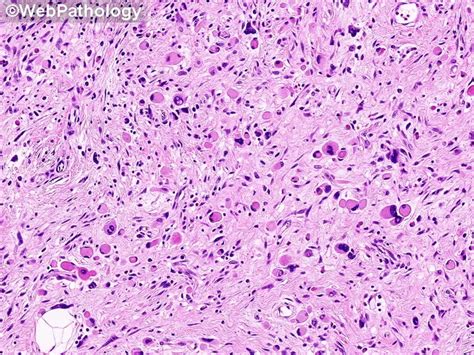 Dedifferentiated Liposarcoma Microscopic Features