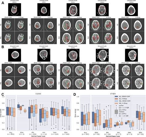 Examination Level Supervision For Deep Learning Based Intracranial Hemorrhage Detection On Head