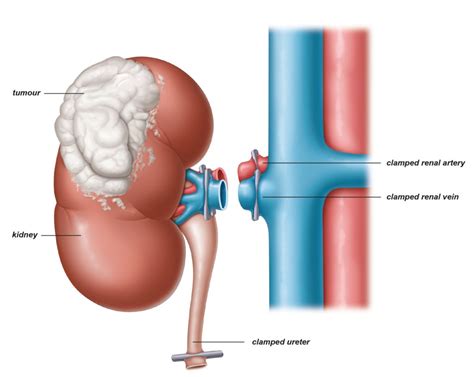 Radical Nephrectomy In Iran Medpersia Medical Tourism