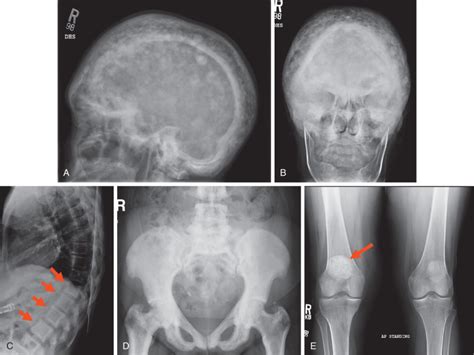 Pagets Disease Radiology Key