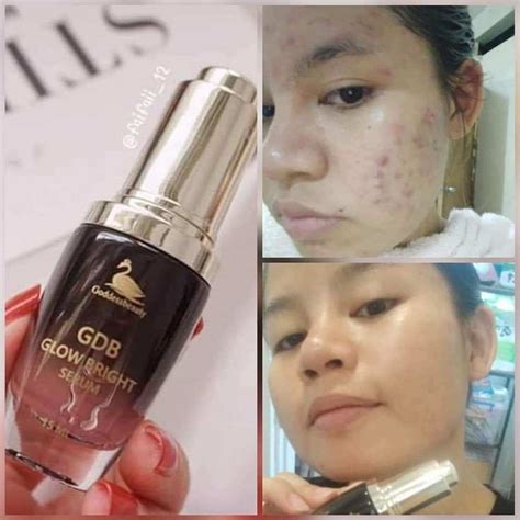 Skinecareမသုံးတတ်တဲ့သူလား ဝက်ခြံထွက်လို့စိတ်ညစ်နေလား တင်းတိတ်တွေများနေလို့စိတ်ညစ်နေတာလား Glow