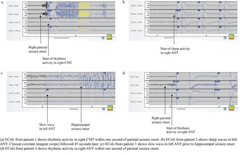 Thalamic Responsive Neurostimulation And Electrocorticograms A Case Series