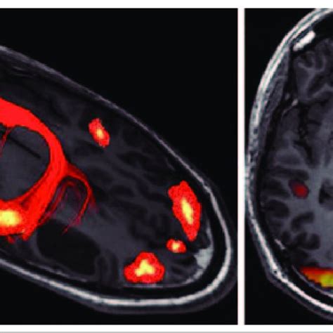 Arcuate Fasciculus Interconnecting The Brocas And Wernickes Language Download Scientific