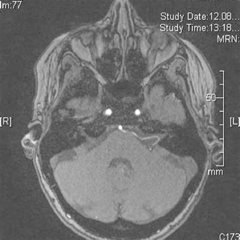 A Left Retrosigmoid Craniotomy With Cranioplasty Was Performed In The
