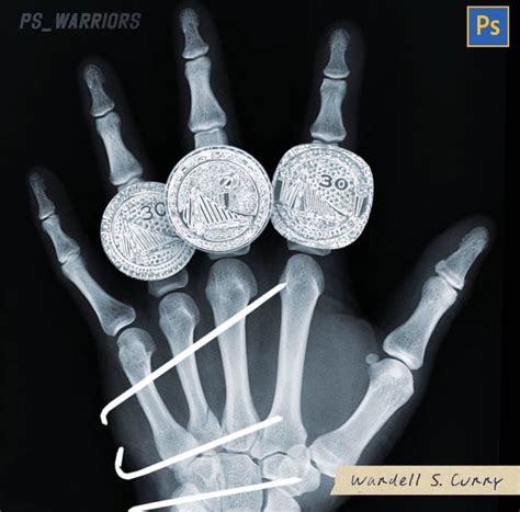 Broken Metacarpal X Ray