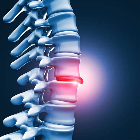 Bulging Disc Treatment Dallas And Frisco Bulging Disc Specialist Dfw