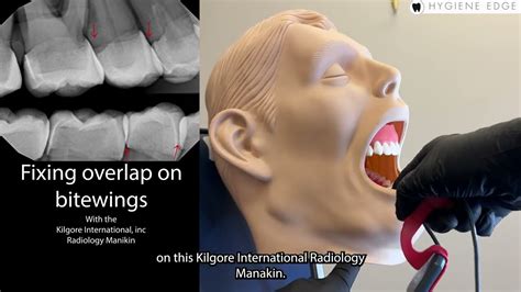 Your Guide To Bitewing Dental X Rays Are They Necessary