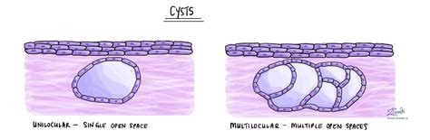 Cyst Pathology Dictionary Mypathologyreport Ca