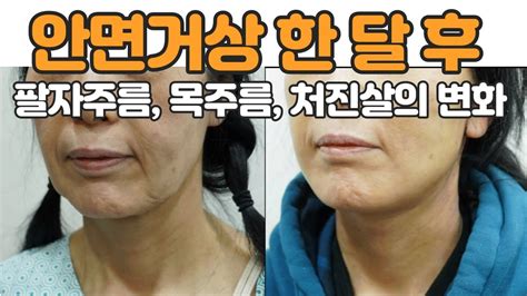안면거상 한 달 후 팔자주름 목주름 처졌던 얼굴 변화 Youtube