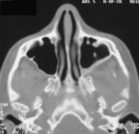 Computed Tomography Axial Projection At 12 Months Download