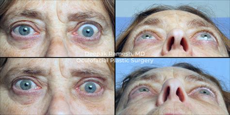 What Is Orbital Decompression Deepak Ramesh Md Somerset Nj