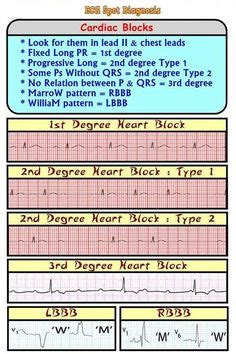 The Heart Block Poem Great Diagram To Remember Some Rhythms Nursing
