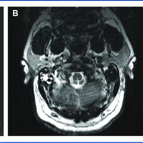 Postoperative Brain Mri After First Resection Attempt Demonstrating