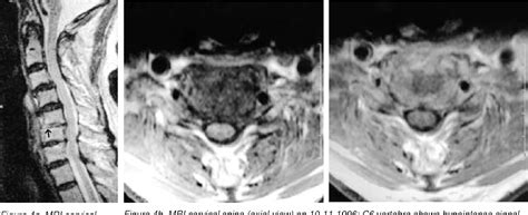 Figure 1 From Streptococcus Bovis Endocarditis With Vertebral Osteomyelitis Spondylodiscitis