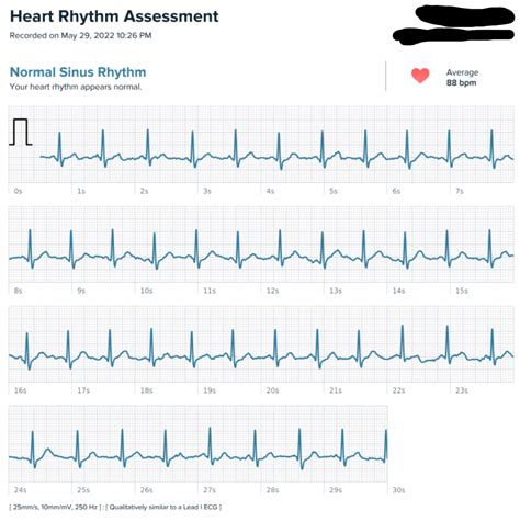 Normal Ecg Reading