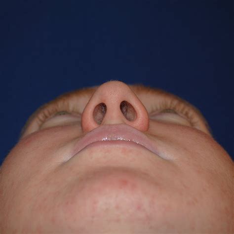 Deviated Septum Pictures