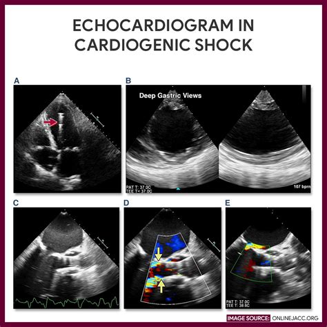 Echocardiogram Nursing Responsibilities Nurseslabs