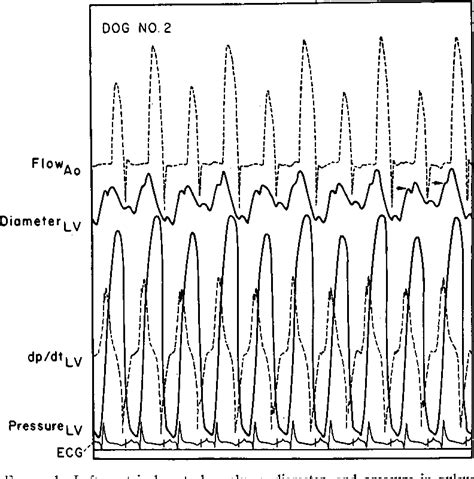 Figure 1 From The Demonstration Of Alternating Contractile State In Pulsus Alternans Semantic