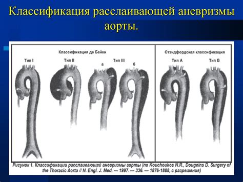 Аневризма аорты презентация онлайн