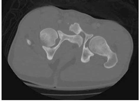 A CT Scan Reveals A Lateral Compression Pelvic Fracture With A