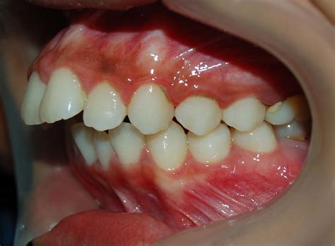 Aryabrahmanta Evaluation Of Class Ii Div 1 Malocclusion Using Icon And Its Relationship To The