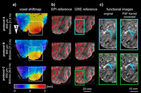 Impact Of Phase Encoding Bandwidth On Geometric Distortions And The Download Scientific