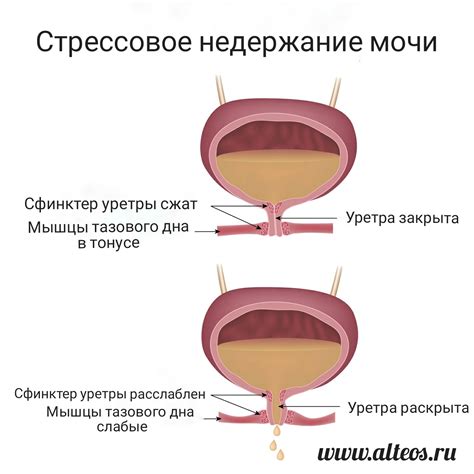 Недержание мочи у женщин почему это не норма