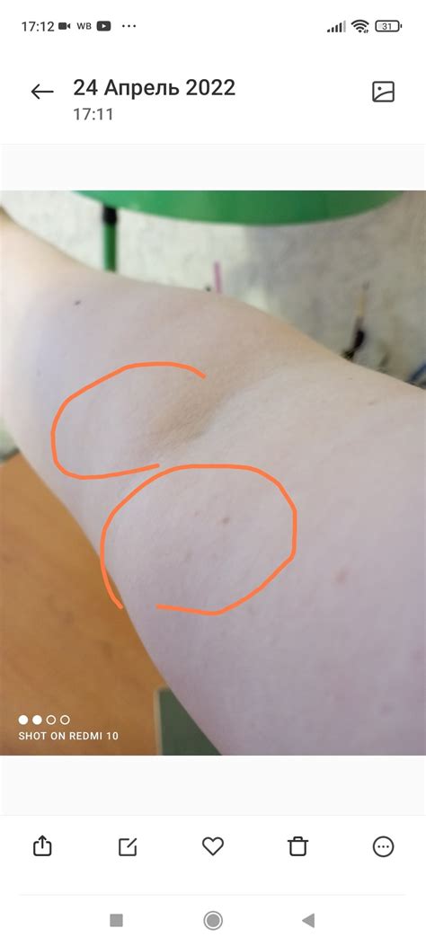 Как расположены лимфоузлы в паху у женщин фото