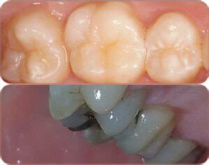 Black Spot On A Molar Tooth What To Do