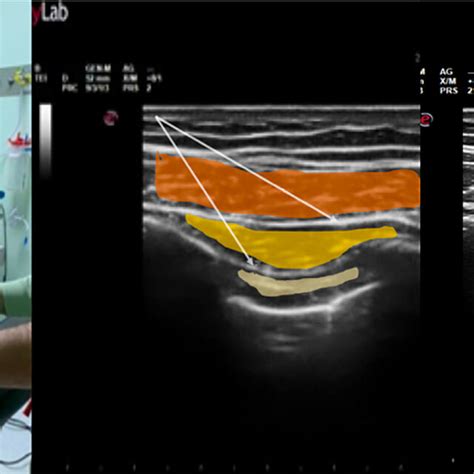 Patient Position And Sonoanatomy Of The Pectoral Nerve Block I And Ii Download Scientific