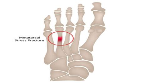 Stress Fracture In The Foot Causes And Symptoms