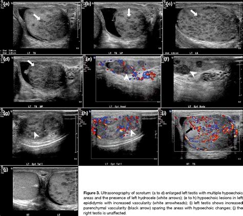 Orchitis Ultrasound