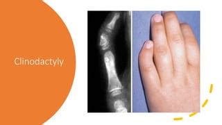 Congenital Hand Deformities Copy Pptx