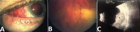 The Patient Who Presented With Mild Proptosis Conjunctival Redness And The Patient Who Presented With Mild Proptosis Conjunctival Redness And