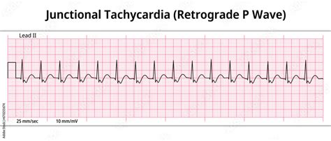 Ecg Junctional Tachycardia Retrograde P Wave 8 Second Ecg Paper