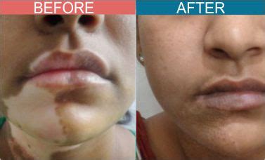 Punch Graphting Treatment For Vililigo In Jaipur Punch Graphting For