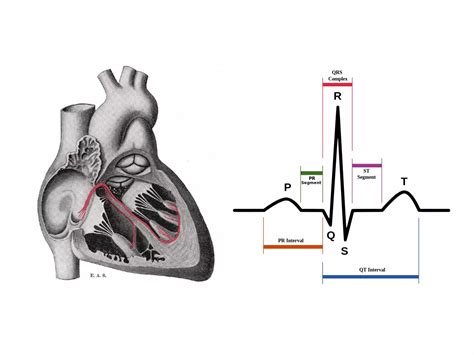 Ecg Lecture Sinus Arrest Sinoatrial Exit Block Av Block And Escape Rhythms Ppt