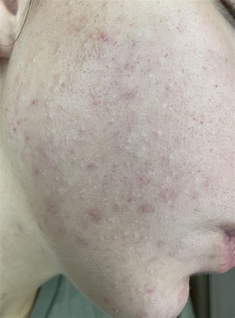 Acne How To Fight With Comedones Rskincareaddiction