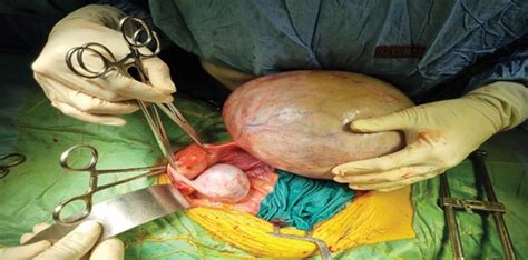 Fig 3 Intraoperative Finding