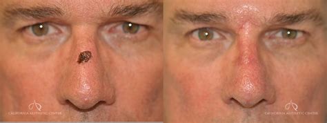 Skin Flap Before And Afters Huntington Beach