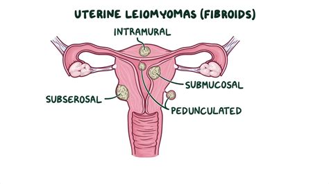Uterine Leiomyoma Clinical Sciences Osmosis Video Library
