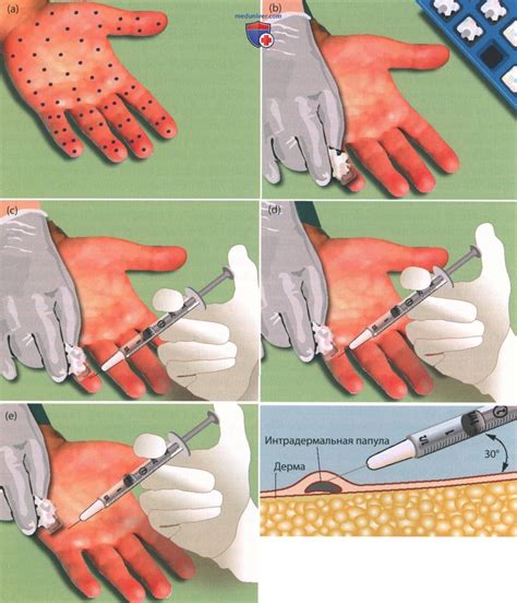 Лечение ботулотоксином ладонного гипергидроза потливости кистей рук