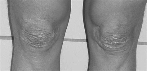 Clinical And Genetic Aspects Of Ehlers Danlos Syndrome Classic Type