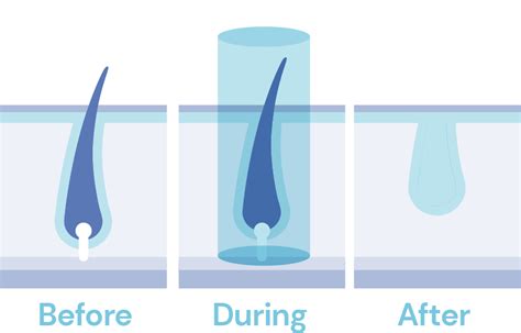 Laser Hair Removal Anaesthesia Uses Emla
