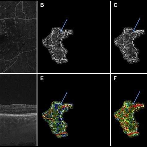 Multimodal Longitudinal Imaging Of Chronic Choroidal Neovascularization Download Scientific