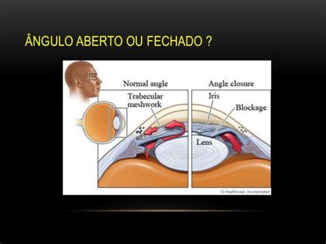 Glaucoma Agudo De ângulo Fechado Acute Angle Closure Glaucoma