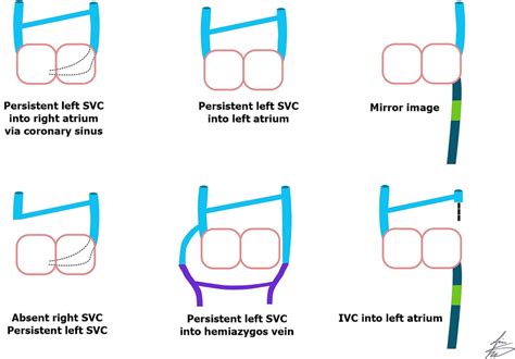 the illustration shows a persistent left superior vena cava svc and download scientific