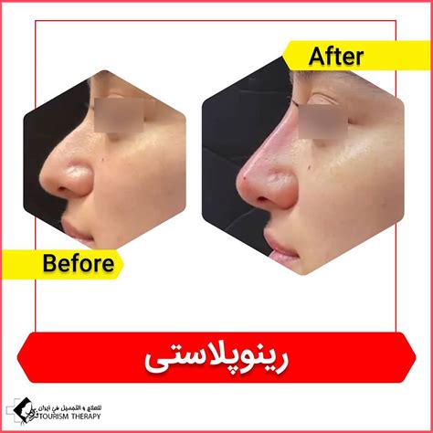 المواصفات والسعر وحجز موعد تجميل الأنف الدكتور رضا حسامي