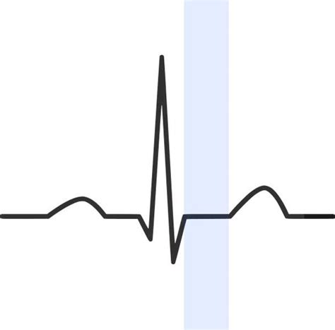 Abnormal Ecg Ii St Segment Shifts In Cardiac Pathophysiology Flashcards Quizlet