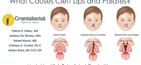 Hare Lip Causes Diagnosis And Treatment Healthy Food Near Me